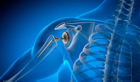 Total Shoulder Replacement For Fort Worth Southlake And Weatherford