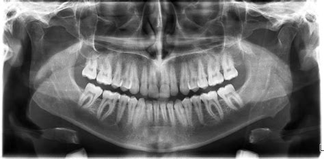 Risks Of Class Ii Maxillo Mandibular Advancement Rjawsurgery