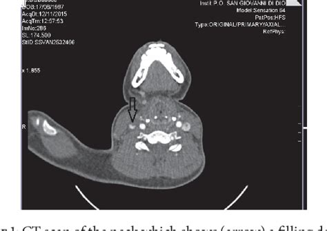 Figure 1 From Fusobacterium Necrophorum Pharyngitis Complicated By