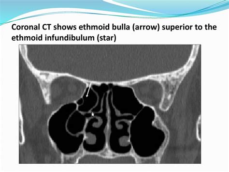 Ethmoid Infundibulum