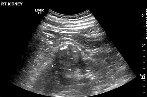 An Incidental Finding Of An Asymptomatic Renal Mass Sonohive