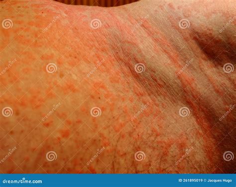 A 60 Year Old Man With A Rash All Over His Body Caused By Allergies