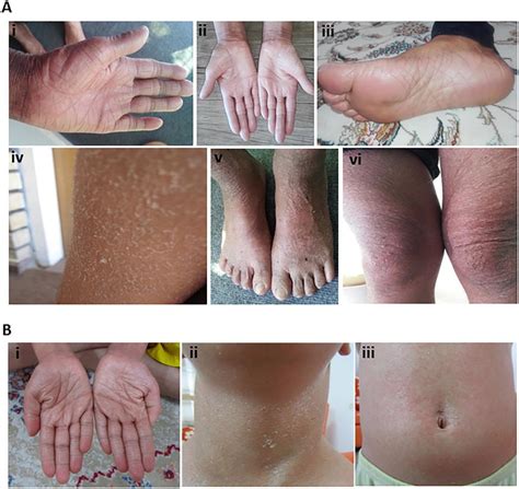 Congenital Ichthyosis