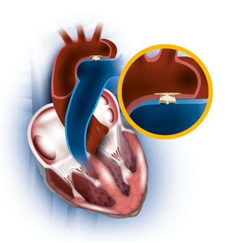 Heart Defect Pda Occlutech Perfecting Performance