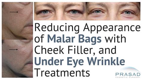 Best Way To Correct Malar Bags Jrau