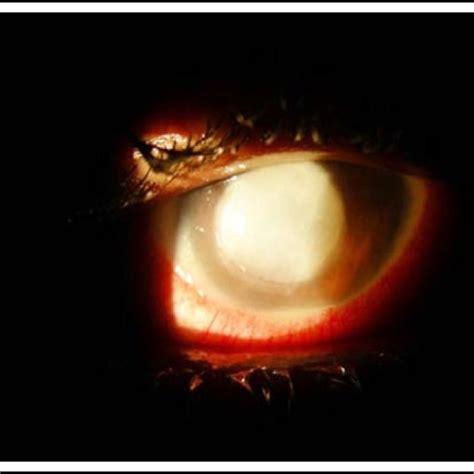 A 30 Year Old Lady With Central Corneal Abscess Improved Rapidly