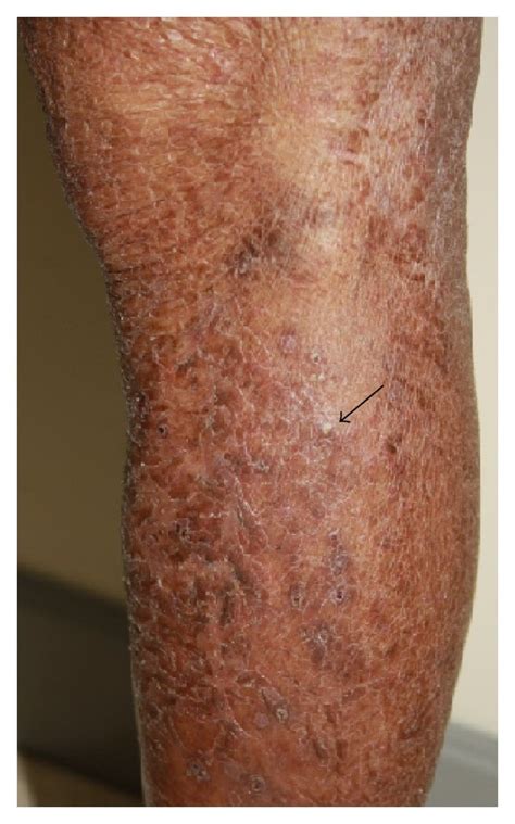 What Is Xerosis Dry Skin Nfhqwp