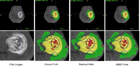 Evidence Fusion With Contextual Discounting For Multi Modality Medical