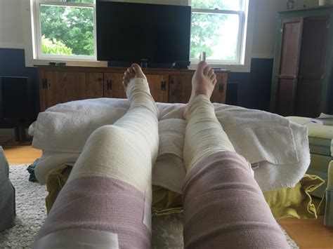 Woman Suffers Horrific Burns Blisters After Touching Invasive Wild