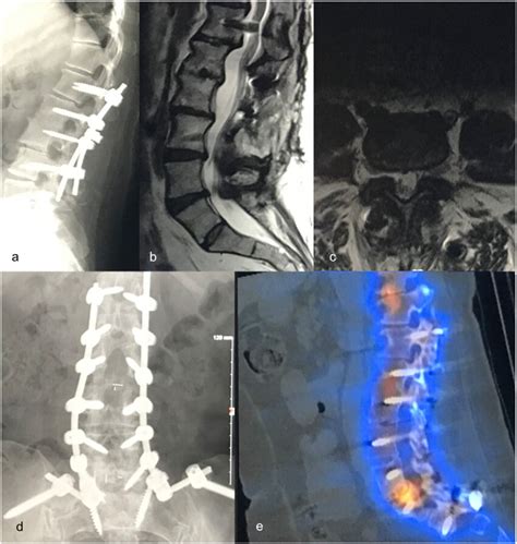 Lumbarisation L56 A Pre Existing L1 L4 Spinal Instrumentation
