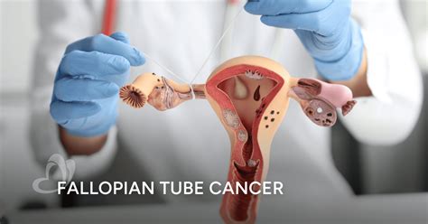 Fallopian Tube Cancer Symptoms Causes And Treatment Thomson Medical