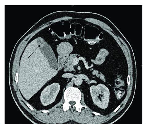 Abdominal Ct Scan Showing Fundic Thickening Of The Gallbladder