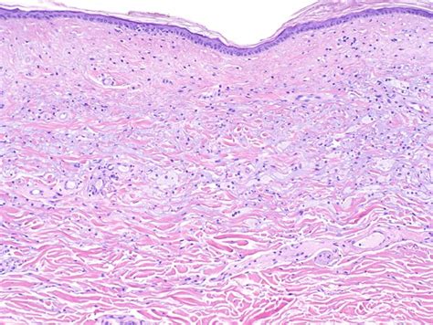 Diffuse Normolipemic Plane Xanthoma Associated With Monoclonal Gammopathy Abstract Europe Pmc