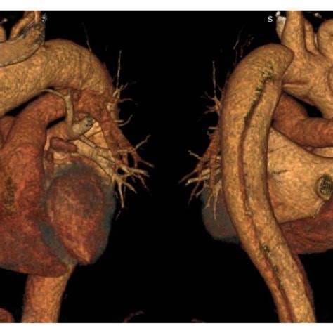 Pdf Successfully Superior Mesenteric Artery Stenting In Operated Type A Aortic Dissection