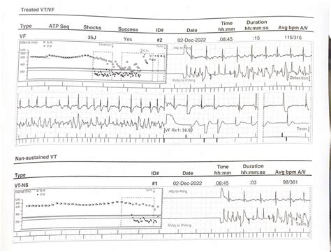 Hendre Van Rensburg En Linkedin Medtronic Pacemaker Electrophysiology Cardiology
