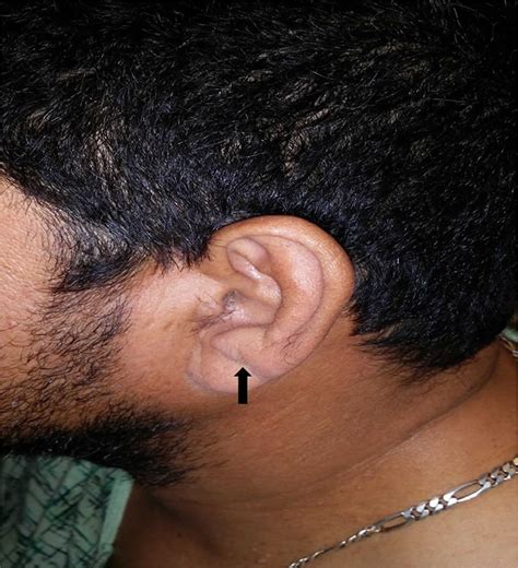 Franks Sign Earlobe And Franks Sign Heart Disease