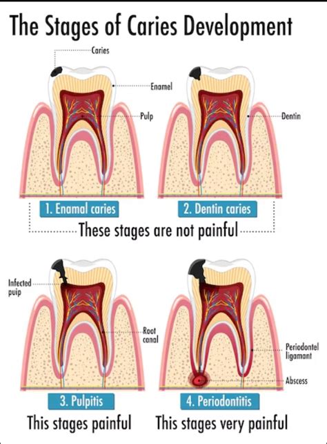 The Root Canal Process A Step By Step Guide