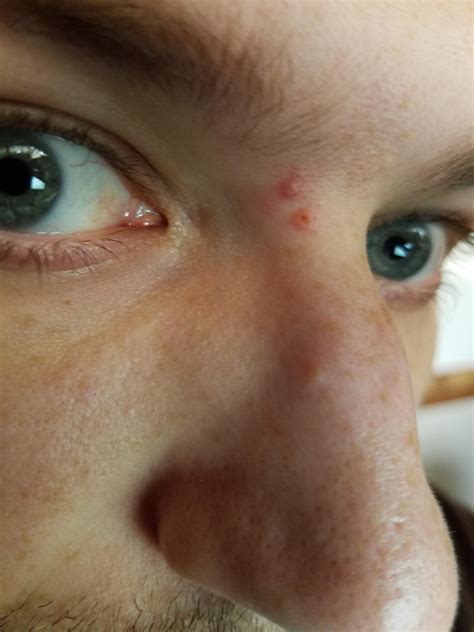 New Acne Between Eyebrows General Acne Discussion Forum