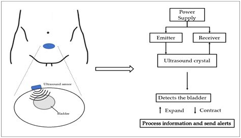 Bladder Monitoring System At Denise Feliciano Blog