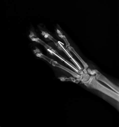 Artrovet Fractura De Metacarpianos