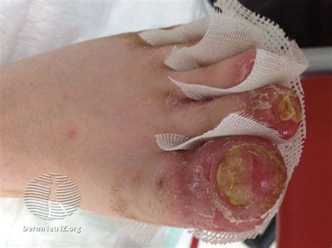 Acrodermatitis Continua Of Hallopeau Ach Is A Rare Inflammatory Disease Characterised By