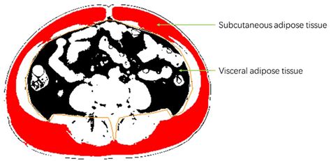 Cross Sectional Abdominal Computerized Tomography Ct Image Of