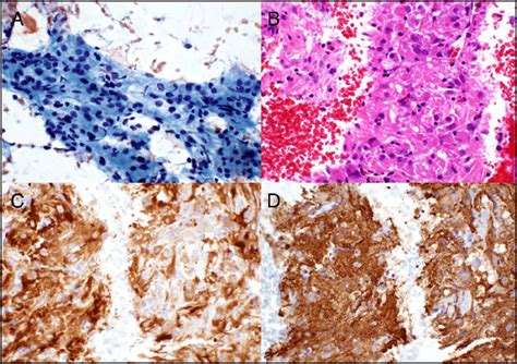Histopathological Slides Of Pancreatic Tail Mass Consistent With