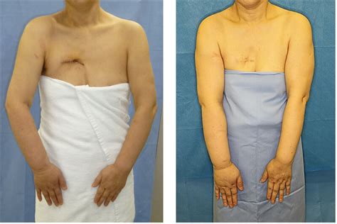 Preoperative And Postoperative Lymphedema Of The Upper Extremity