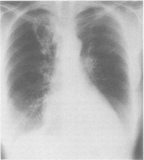 Chest Radiograph Showing A Cavitating Lesion In The Right Upper Lobe
