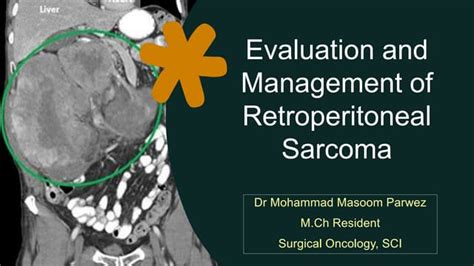 Evaluation And Management Of Retroperitoneal Sarcoma Pptx