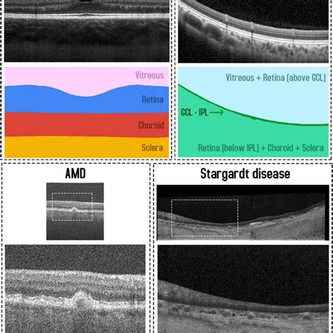 Example Oct Image And Corresponding Semantic Segmentation Mask For Each Download Scientific