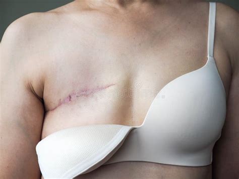 Scar From Total Mastectomy Operation Unrecognized Woman Fight With