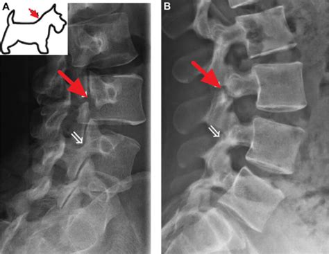 Spondylosis Definition Causes Symptoms Diagnosis Treatment