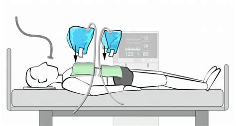 Inflatable Prone Ventilation IPV Ergotrics Patient Positioning
