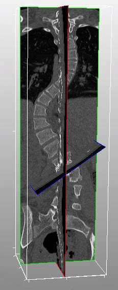 Ct Dicom Files Opened With Devide The Spine Is Visualized In Three Download Scientific Diagram