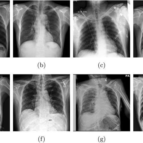 Samples Of Cxr Images From Our Consolidated Dataset A Normal B Download Scientific Diagram
