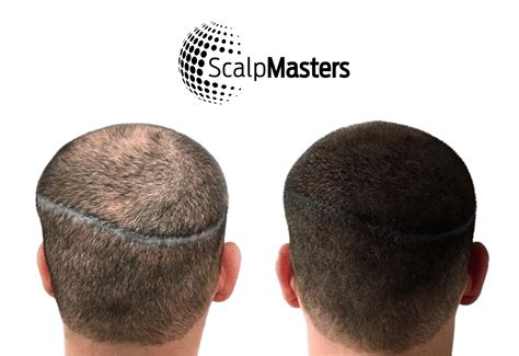 Scars Scalp Conditions Scalpmasters
