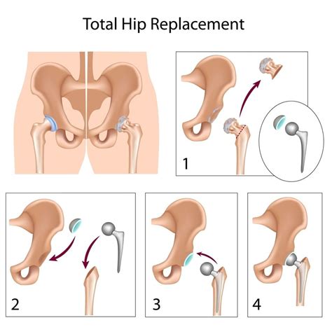 Hip Replacement Pacific Bone And Joint Clinic