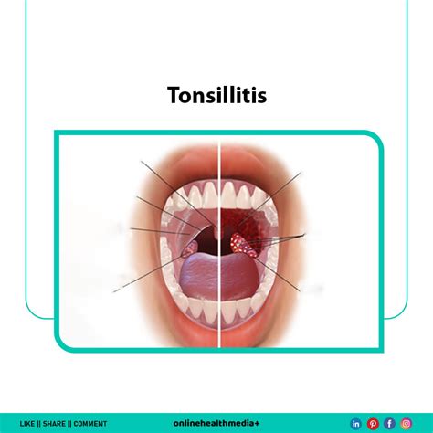 Tonsillitis Is Inflammation Of The Online Health Media