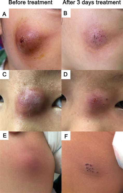 Fire Needle Combined Topical Mupirocin For The Treatment Of Simple Skin