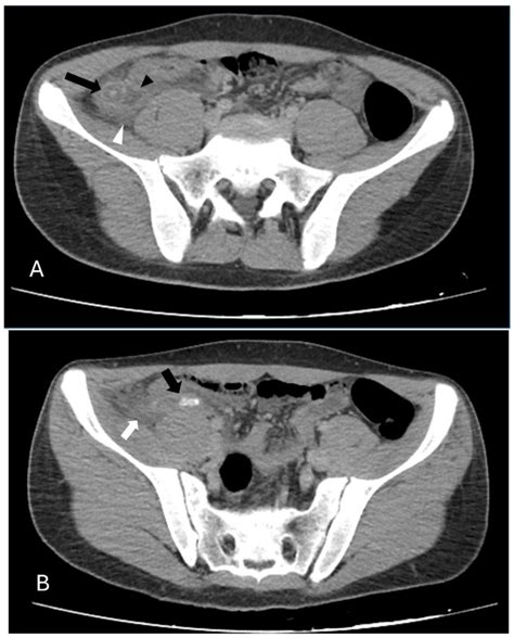 Are Preoperative Ct Findings Useful In Predicting The Duration Of