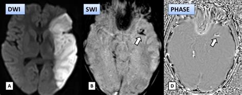 Susceptibility Sign Dwi Showing Restricted Diffusion In The Left Mca