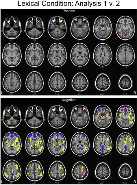 Conjunction Maps Comparing The Location Of Significant Voxels