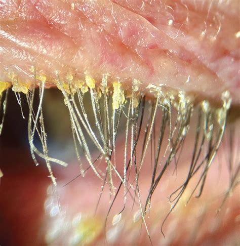 Demodex Blepharitis