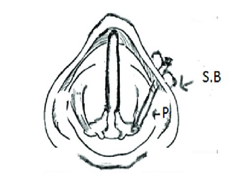 Arytenoid Adduction Technique Muscular Process Of Arytenoid Rotated Download Scientific