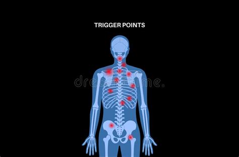 Myofascial Trigger Points Stock Vector Illustration Of Issue 309901769
