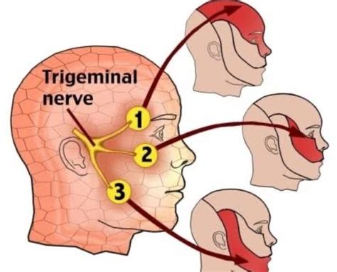 Waspadai Penyakit Trigeminal Neuralgia Nyeri Berbahaya Di Wajah