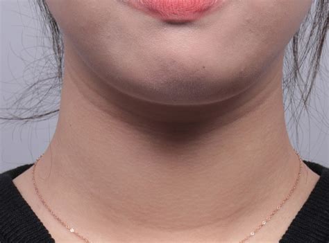 대구이중턱 빠지지 않던 턱 대구v성형외과에서 해결했어요 네이버 블로그