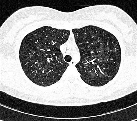Centrilobular Nodules In High Resolution Computed Tomography Of The Download Scientific Diagram