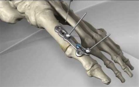 Arthrodesis Mediheal Group Of Hospitals